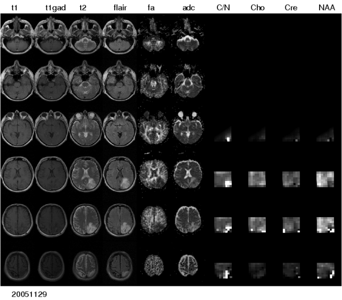 Projects:TumorModeling - NAMIC Wiki