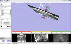 2012 Summer Project Week:Interactive Needle Segmentation - NAMIC Wiki