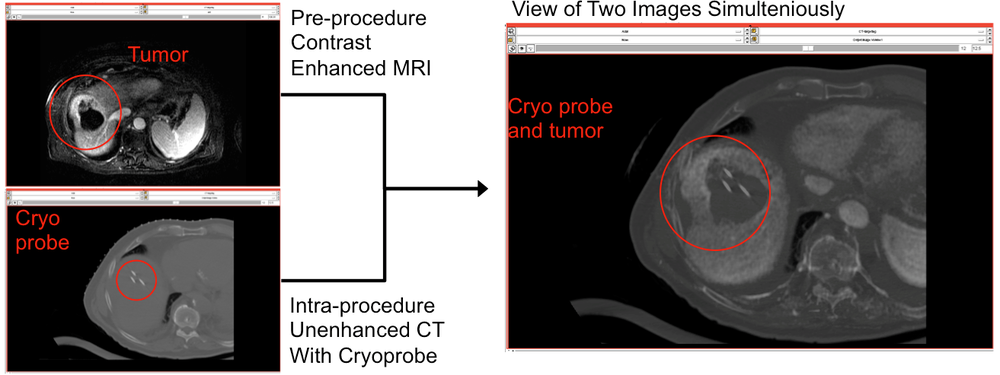 Non-rigid MR-CT Image Registration - NAMIC Wiki