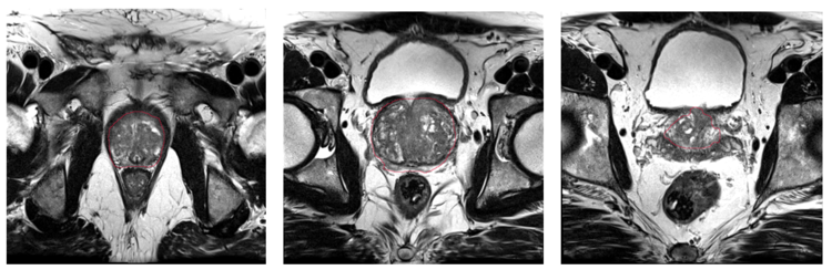 Project Week 25/CNN for multi-plane prostate segmentation - NAMIC Wiki