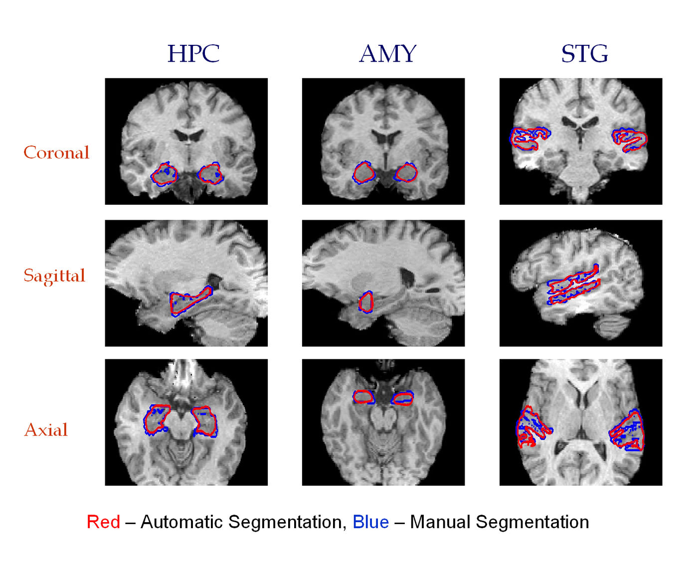 Projects:LatentAtlasSegmentation - NAMIC Wiki