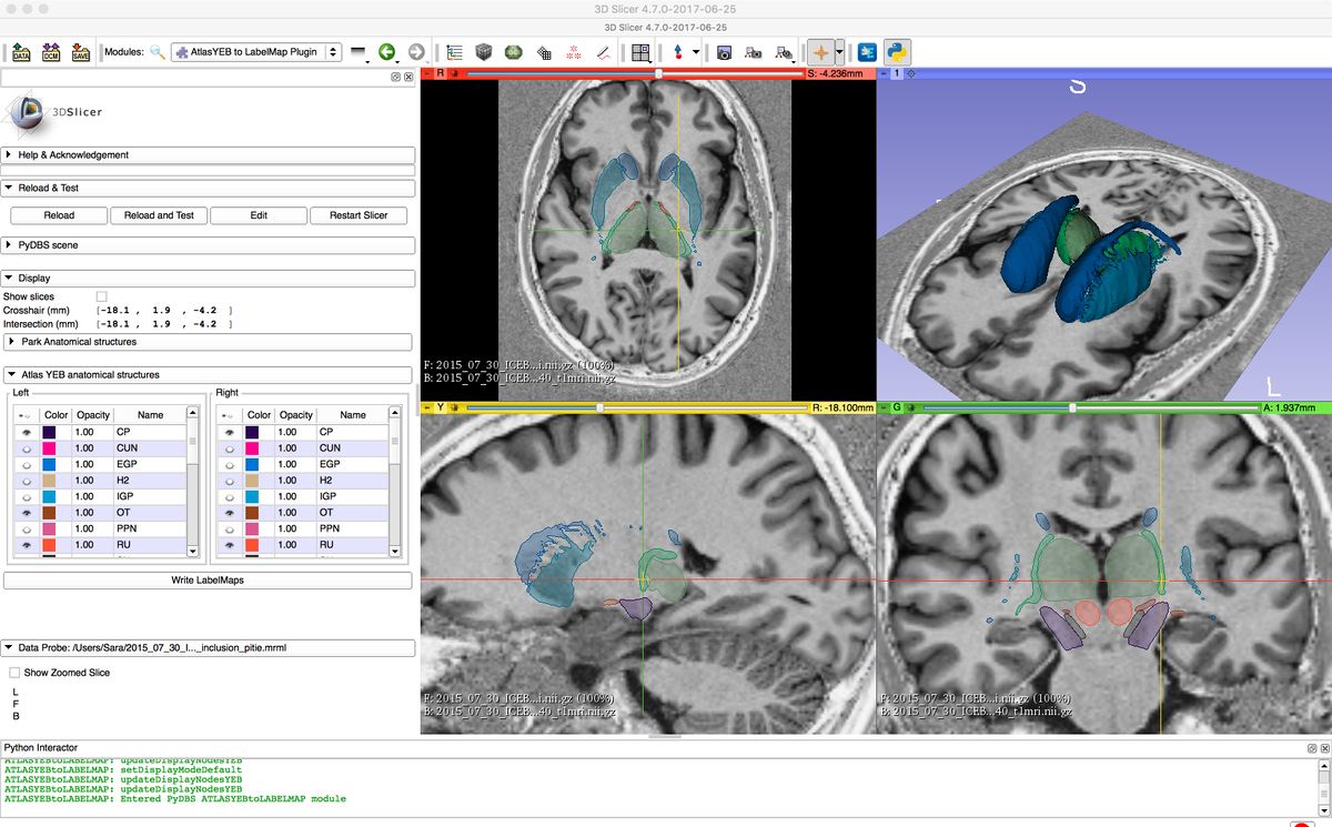 Project Week 25/Surgical Planning In Stereotaxy - NAMIC Wiki