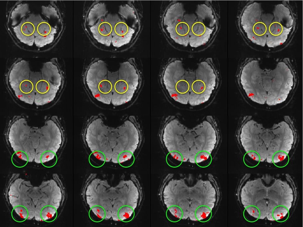 Projects:fMRIClustering - NAMIC Wiki