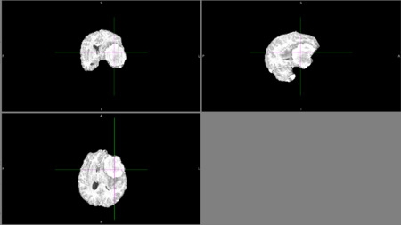 2017 Winter Project Week/MeningiomaSegmentation - NAMIC Wiki