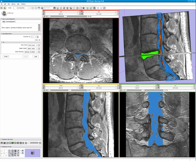 2010 Winter Project Week Spine Segmentation Module in Slicer3 - NAMIC Wiki