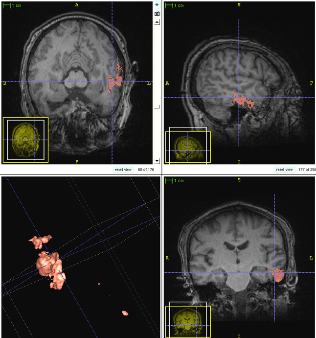 Projects:PathologyAnalysis - NAMIC Wiki