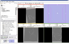 2009 Summer Project Week Project Segmentation of Muscoskeletal Images - NAMIC Wiki