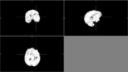 2017 Winter Project Week/MeningiomaSegmentation - NAMIC Wiki